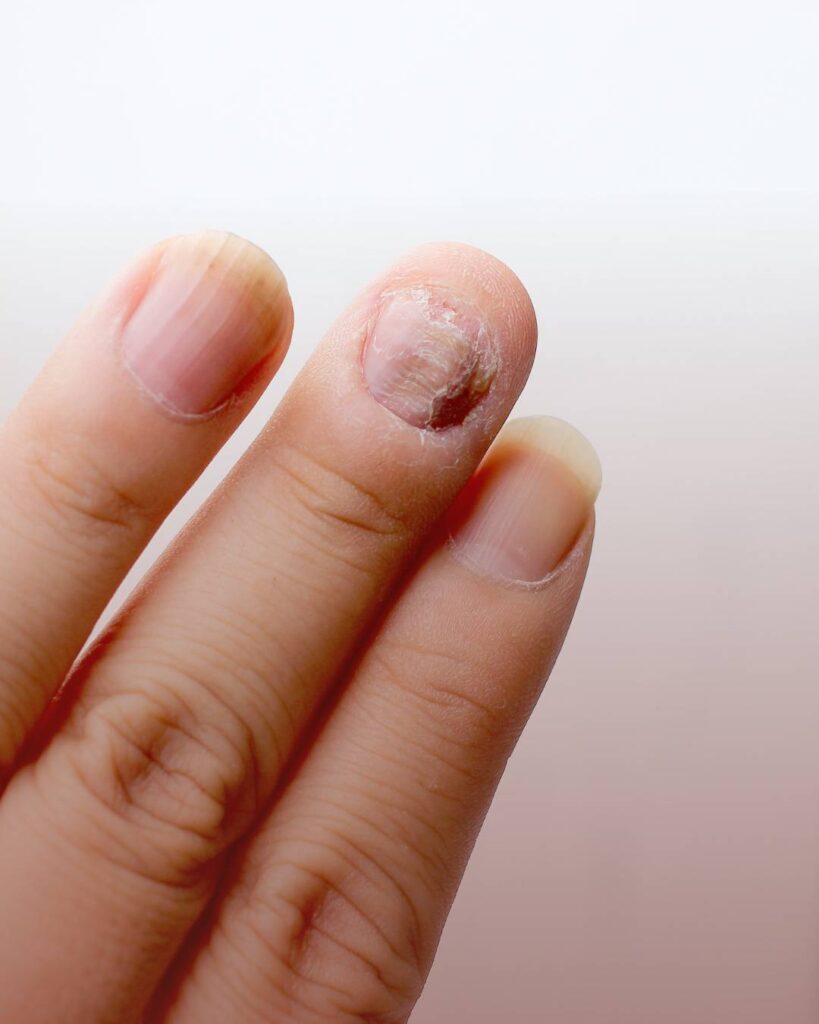 Onicomicose - Instituto Dermatológico de Curitiba - IDC