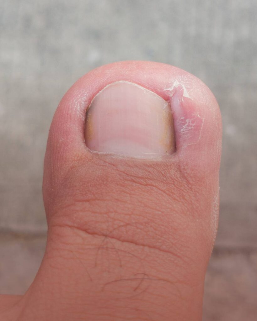 Paroníquia - Instituto Dermatológico de Curitiba - IDC