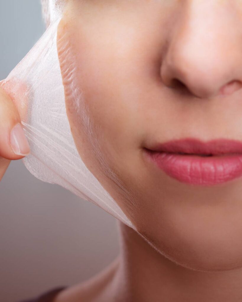 Peelings - Instituto Dermatológico de Curitiba - IDC