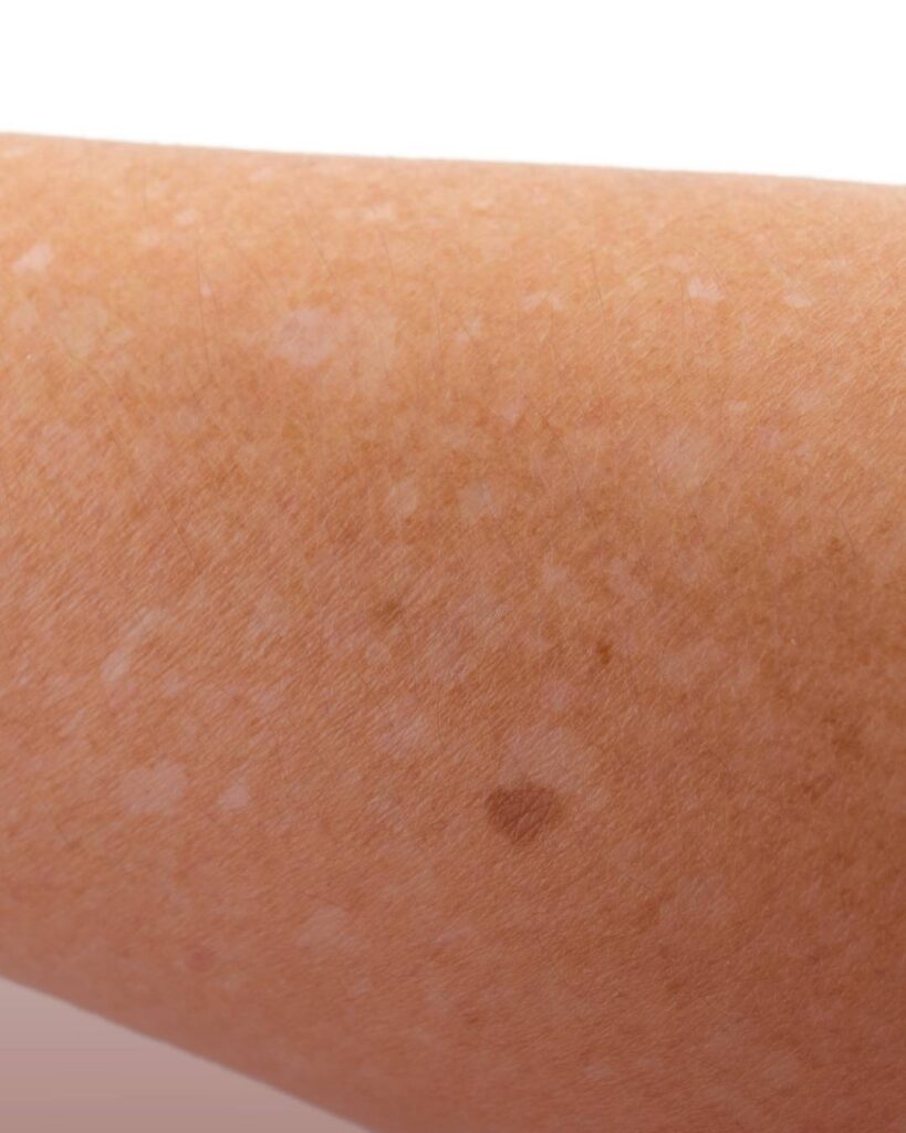 Pitiríase Alba - Instituto Dermatológico de Curitiba - IDC